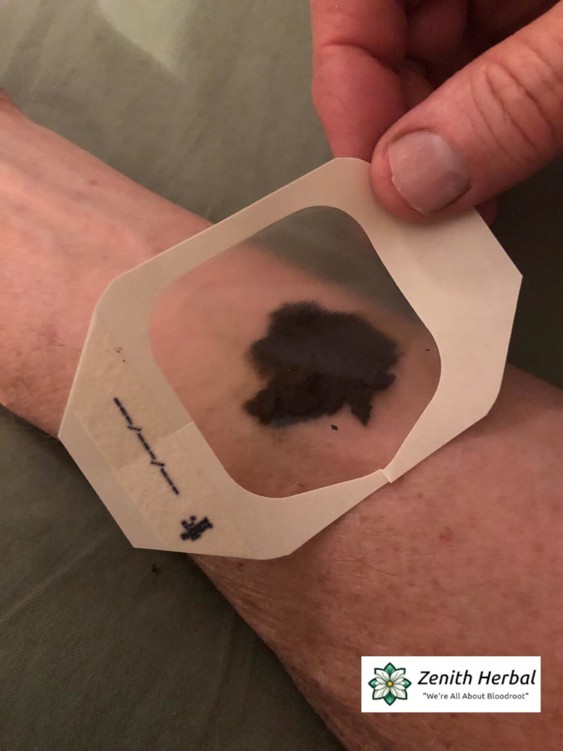 First-Time User Guide to Black Salve | Zenith Herbal