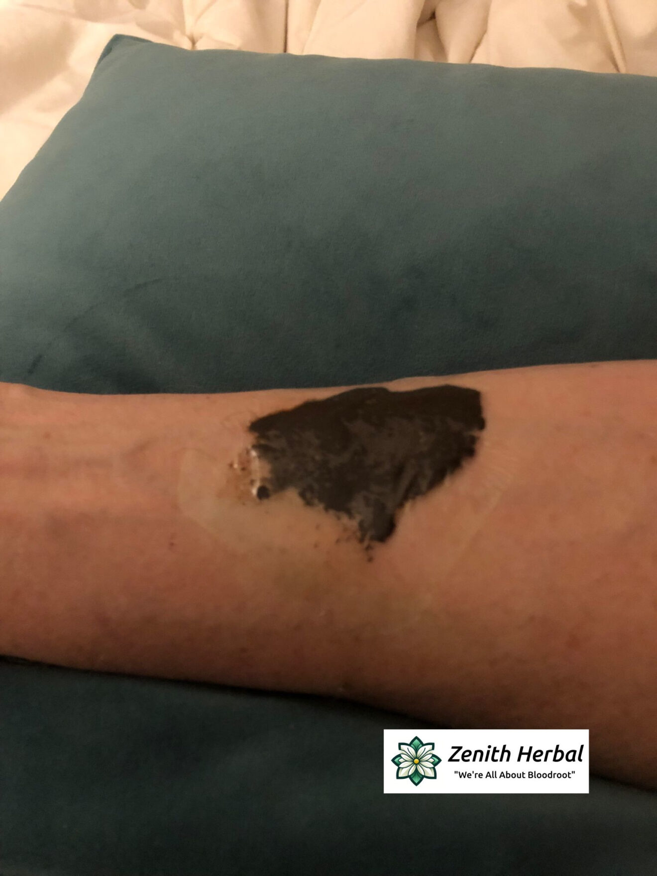 The 7-Step Guide on how to Apply Black Salve | Zenith Herbal